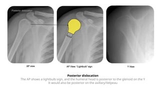 Acute Shoulder Dislocation (Traumatic Dislocation of the Glenohumeral ...