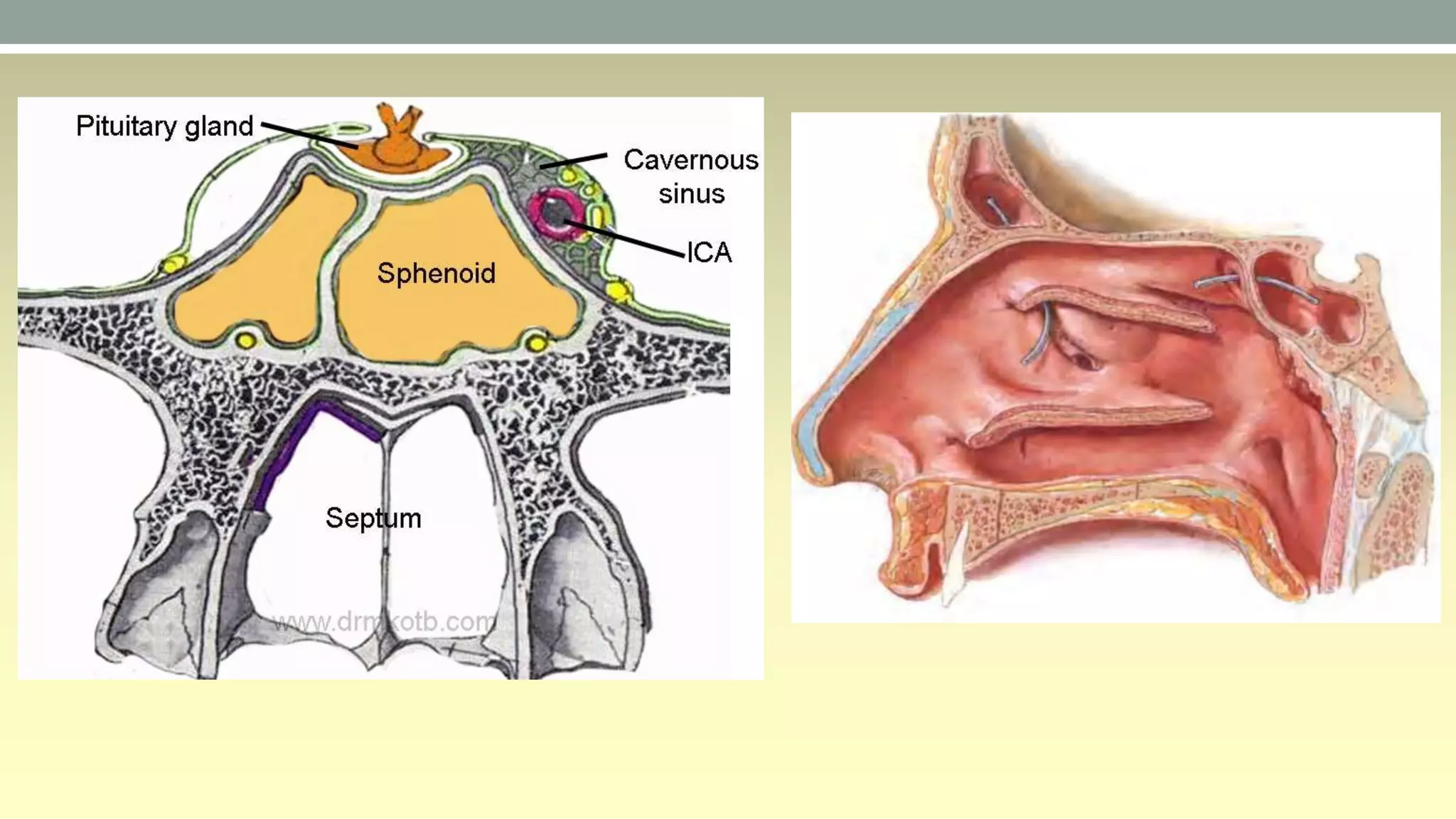 Acute sinusitis | PPTX