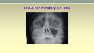 Acute sinusitis | PPTX
