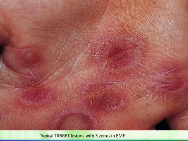 Acute skin failure | PPTX | Skin and Dermatology | Diseases and Conditions