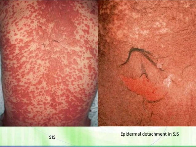 Acute skin failure | PPTX | Skin and Dermatology | Diseases and Conditions