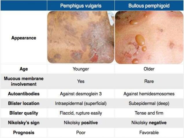 Acute skin failure