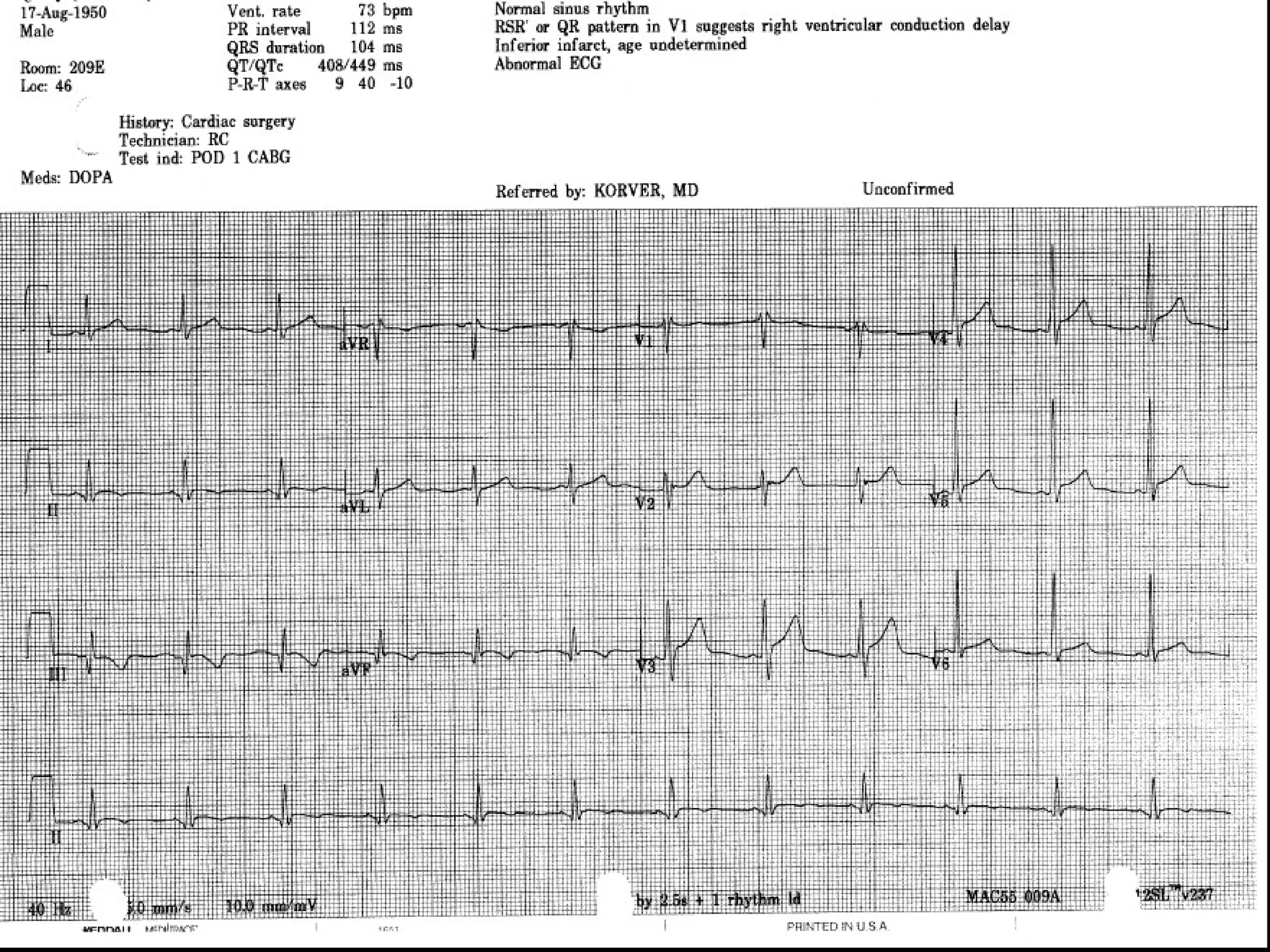 Acute stemi overlay slide presentation | PPT