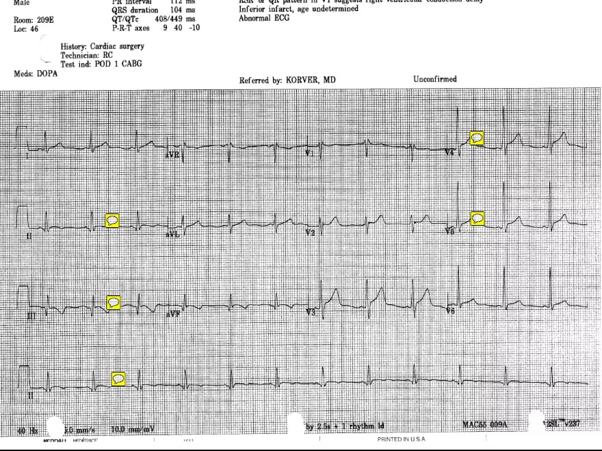 Acute stemi overlay slide presentation | PPT