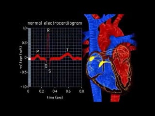 Acute stemi overlay slide presentation | PPT