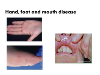Acute stomatitis in children | PDF