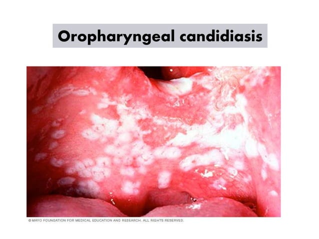 Acute stomatitis in children | PDF | Dental Health | Diseases and ...