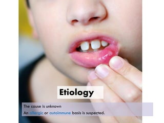 Acute stomatitis in children | PDF