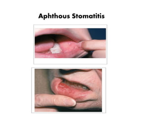 Acute stomatitis in children | PDF