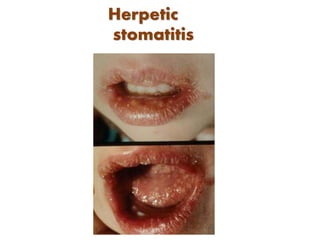 Acute stomatitis in children | PDF