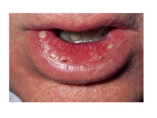 Acute stomatitis in children | PDF