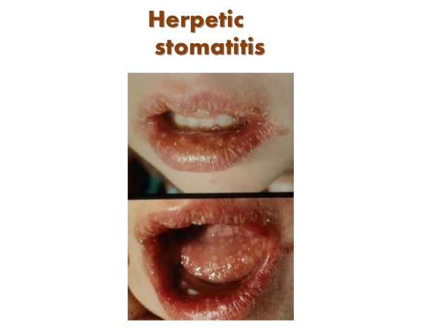 Acute stomatitis in children