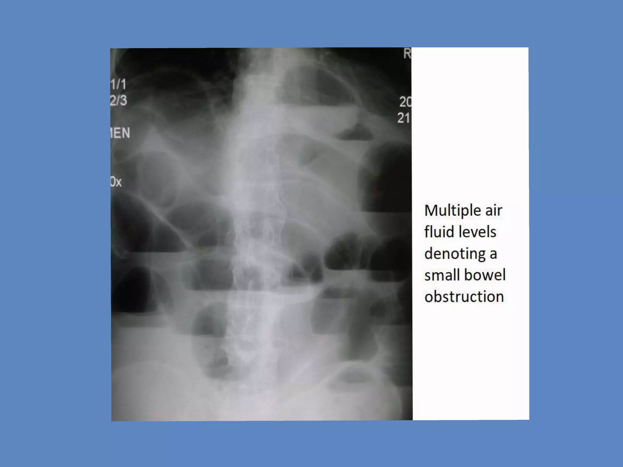 acute Strangulated Intestinal Obstruction -Bhadra.pptx