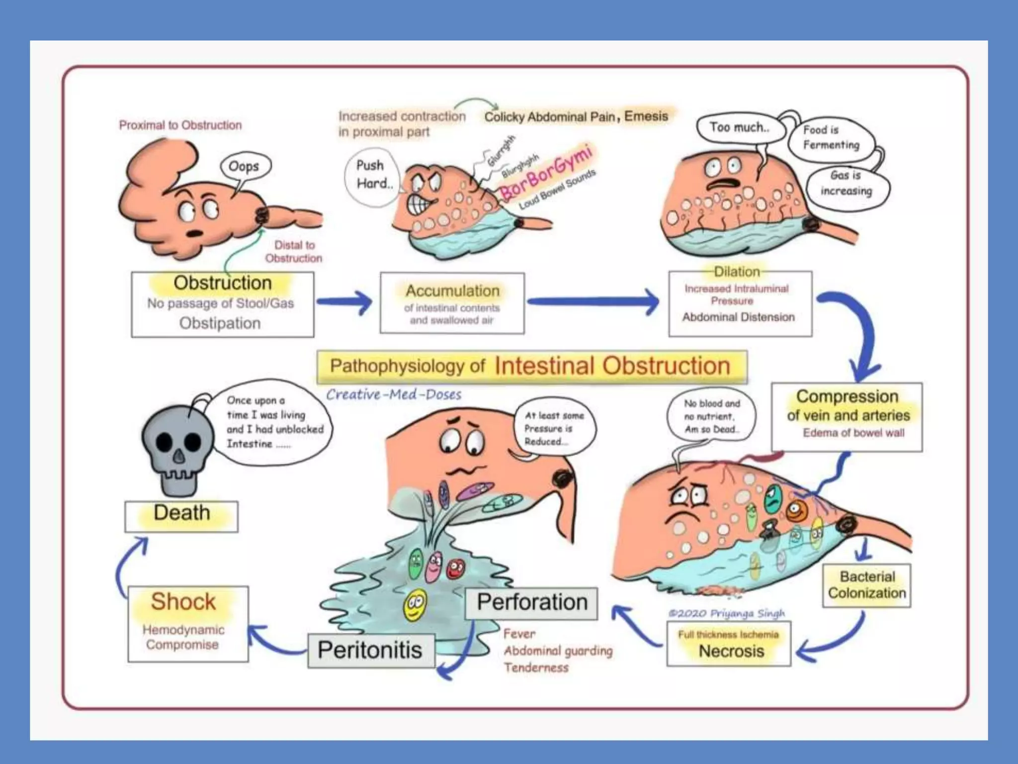 acute Strangulated Intestinal Obstruction -Bhadra.pptx