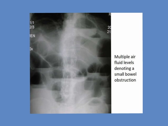 acute Strangulated Intestinal Obstruction -Bhadra.pptx