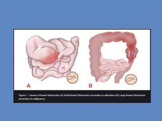 acute Strangulated Intestinal Obstruction -Bhadra.pptx
