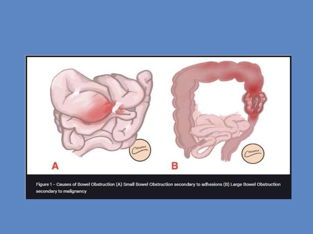 acute Strangulated Intestinal Obstruction -Bhadra.pptx