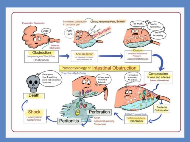 acute Strangulated Intestinal Obstruction -Bhadra.pptx