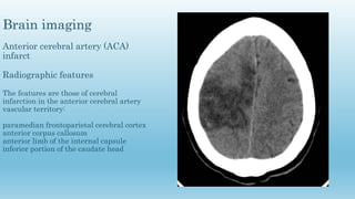 Acute stroke 2019 | PPTX | Brain and Nervous System Disorders ...