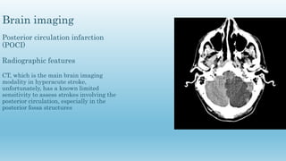 Acute stroke 2019 | PPTX
