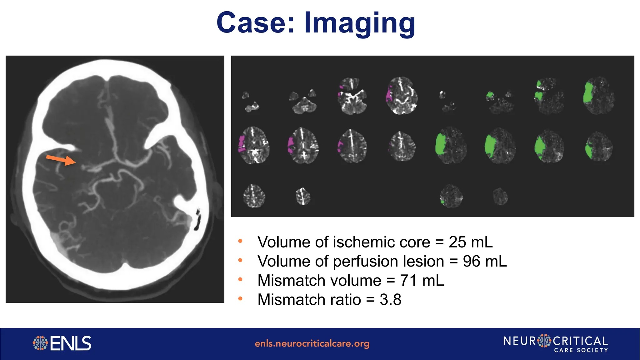 Acute stroke management presentation .pptx