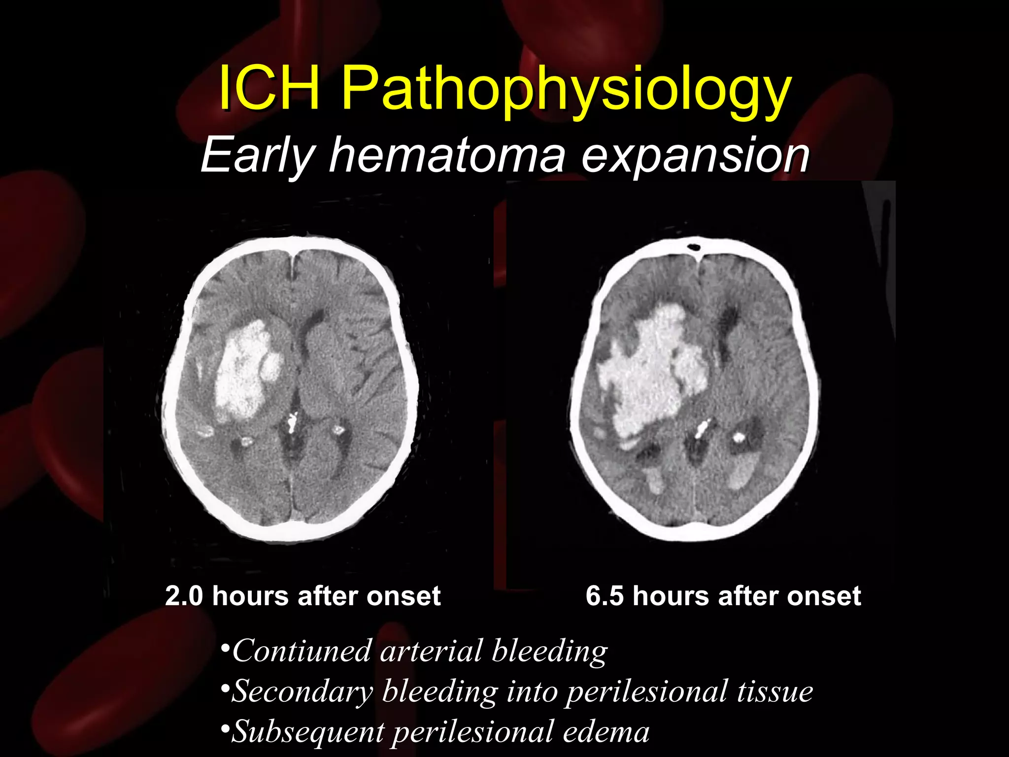 Acute Stroke Management Handouts Power Point885 | PPT