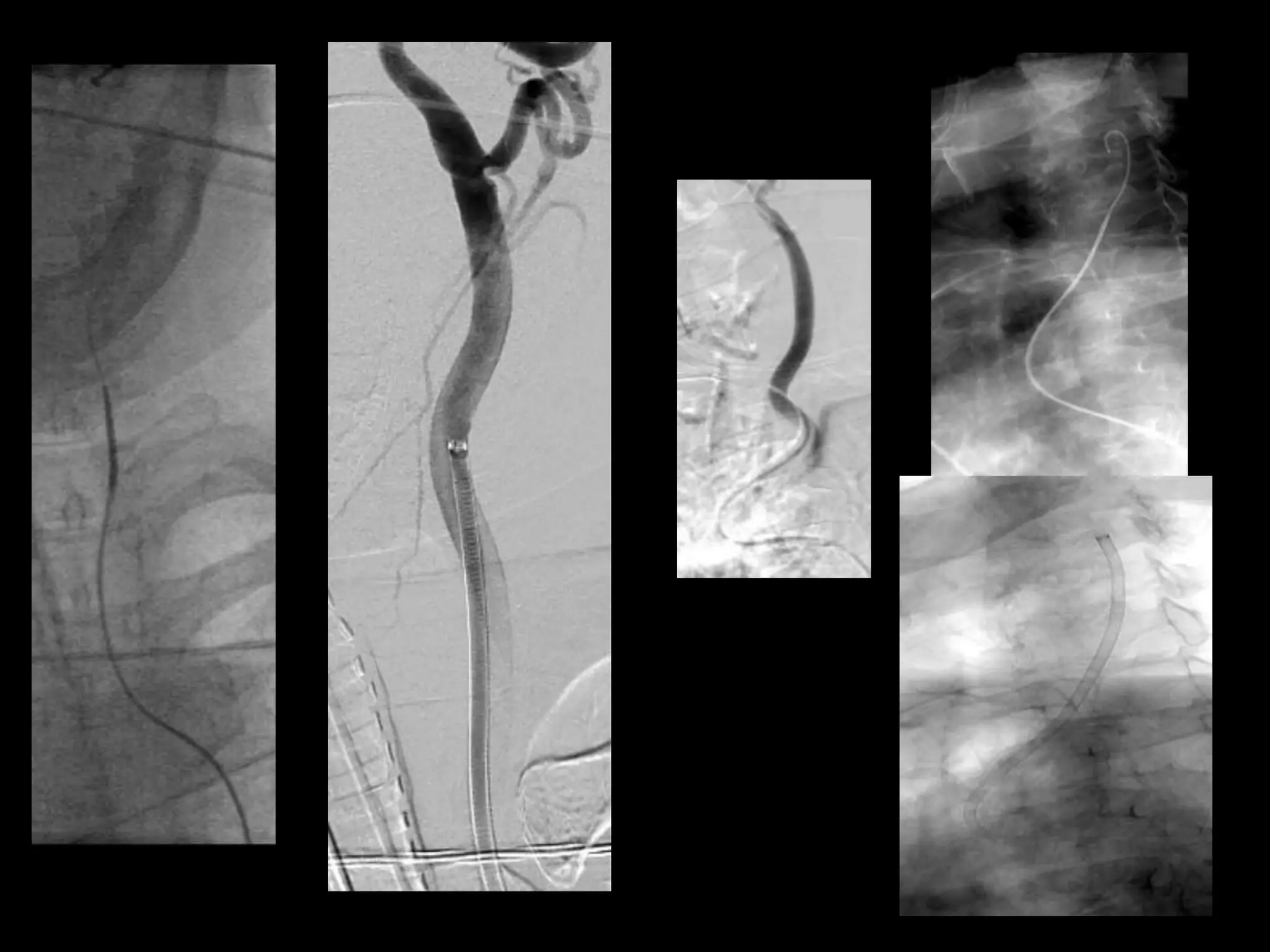 Mechanical thrombectomy with stent retriever | PPTX