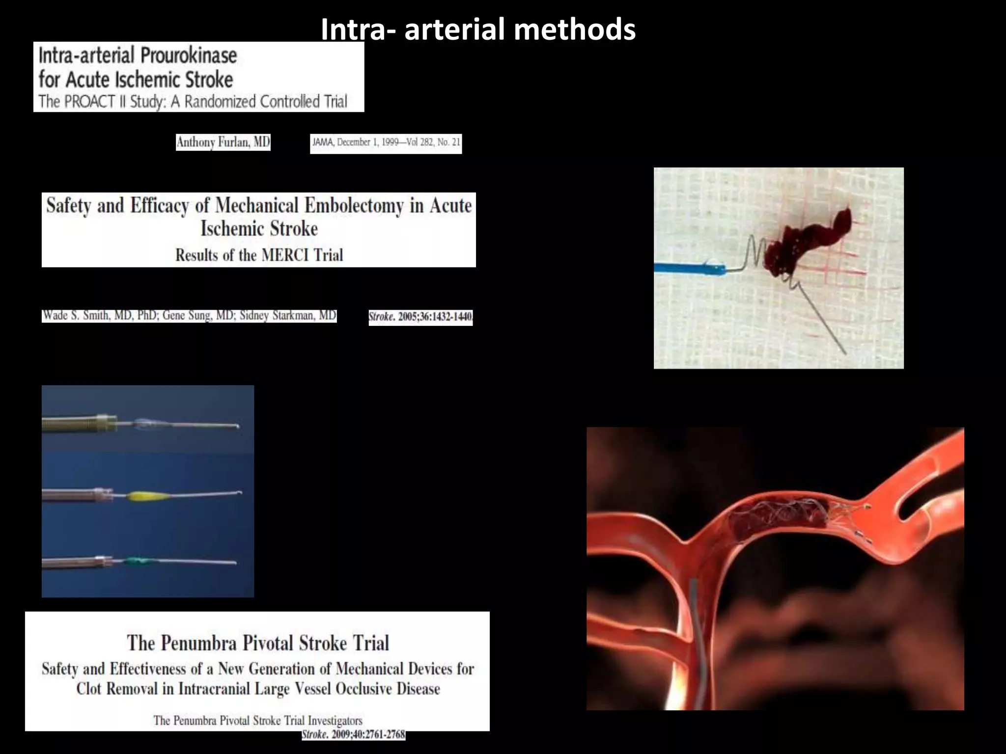 Mechanical thrombectomy with stent retriever | PPTX