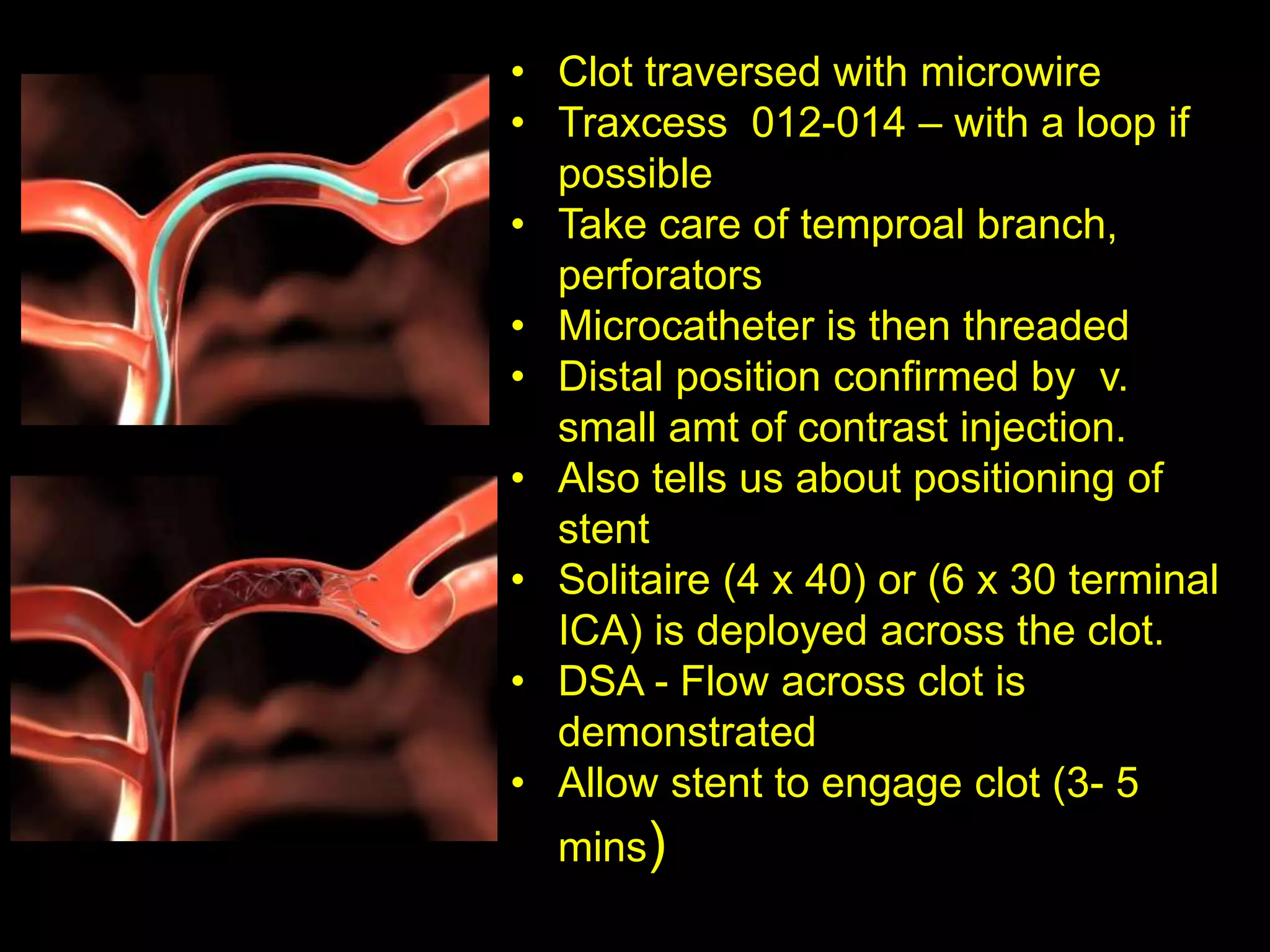 Mechanical thrombectomy with stent retriever | PPT