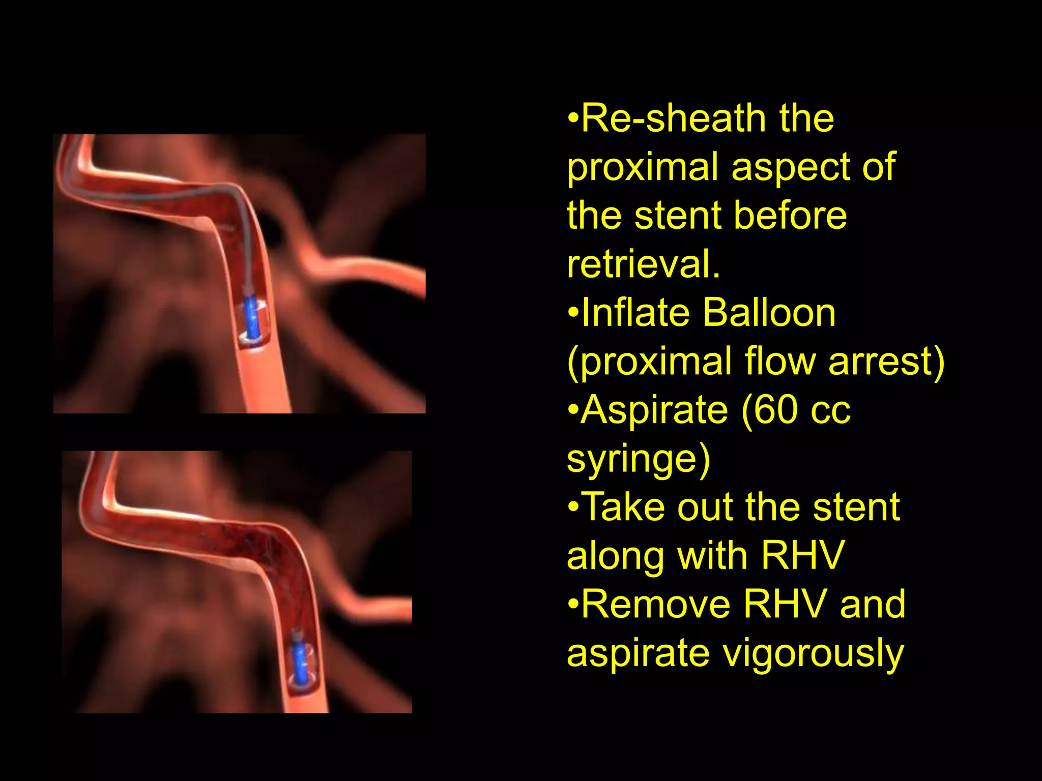 Mechanical thrombectomy with stent retriever | PPTX