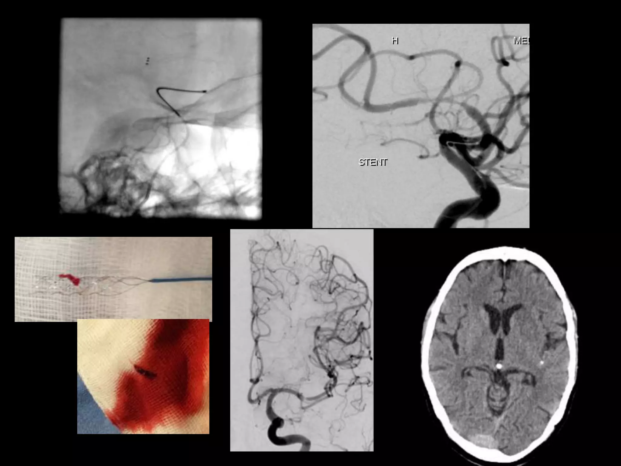 Mechanical thrombectomy with stent retriever | PPTX