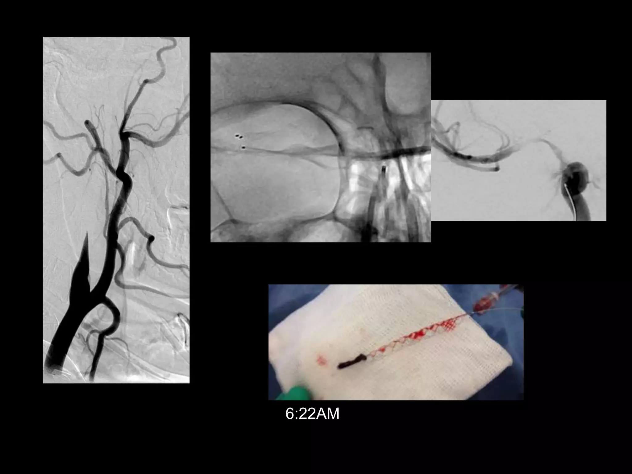 Mechanical thrombectomy with stent retriever | PPTX
