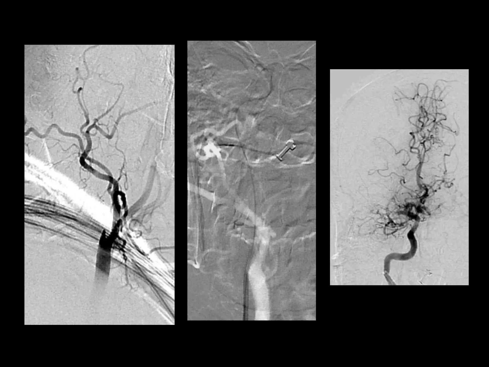 Mechanical thrombectomy with stent retriever | PPTX