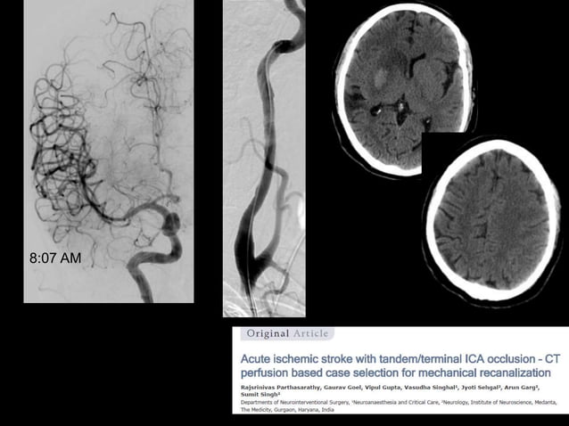 Mechanical thrombectomy with stent retriever | PPTX | Healthcare ...