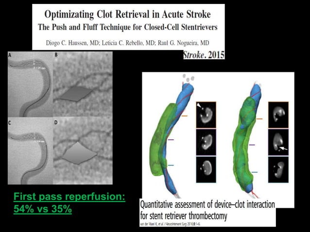 Mechanical thrombectomy with stent retriever | PPTX | Healthcare ...