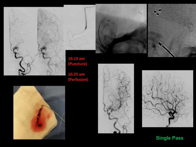 Mechanical thrombectomy with stent retriever | PPTX | Healthcare ...