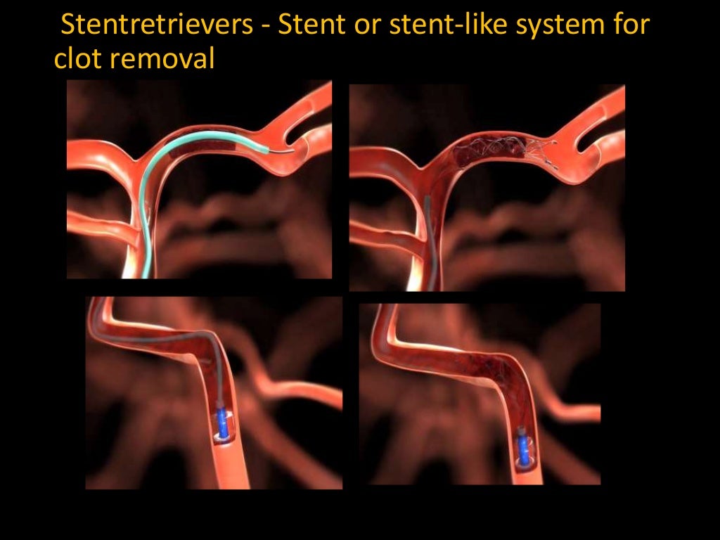 Mechanical thrombectomy with stent retriever