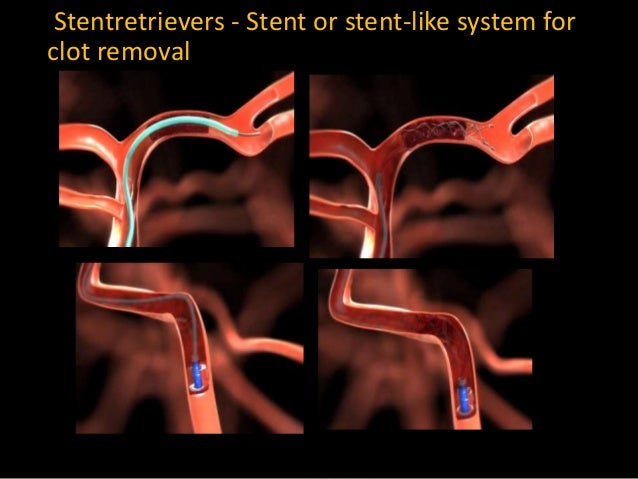 Mechanical thrombectomy with stent retriever