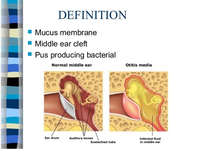 Acute suppurative otitis media