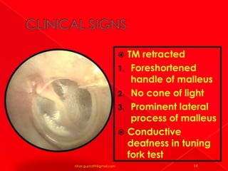 Acute suppurative otitis media | PPTX