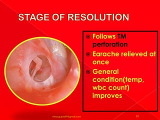 Acute suppurative otitis media | PPTX