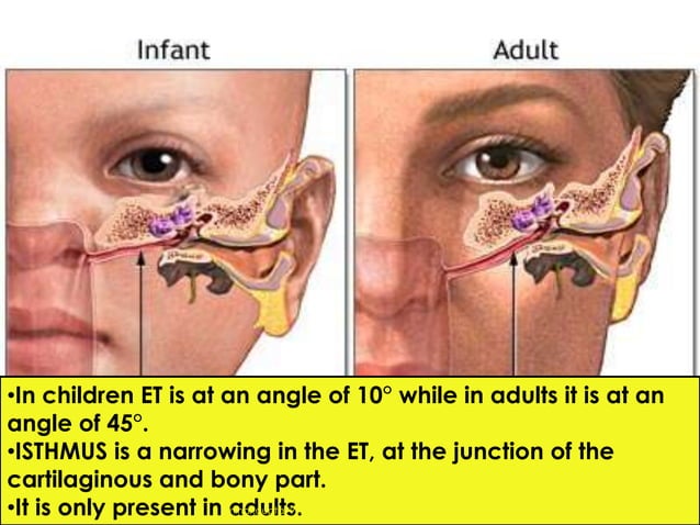 Acute suppurative otitis media | PPTX | Ear, Nose and Throat Conditions ...