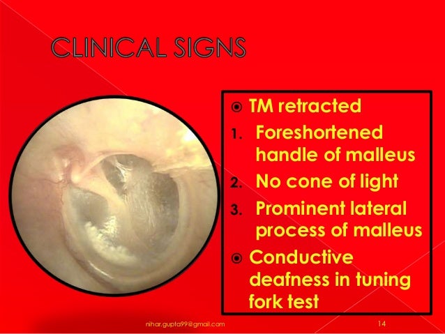Acute suppurative otitis media