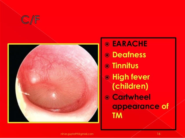 Acute suppurative otitis media