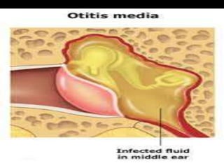 Acute suppurative otitis media | PPT