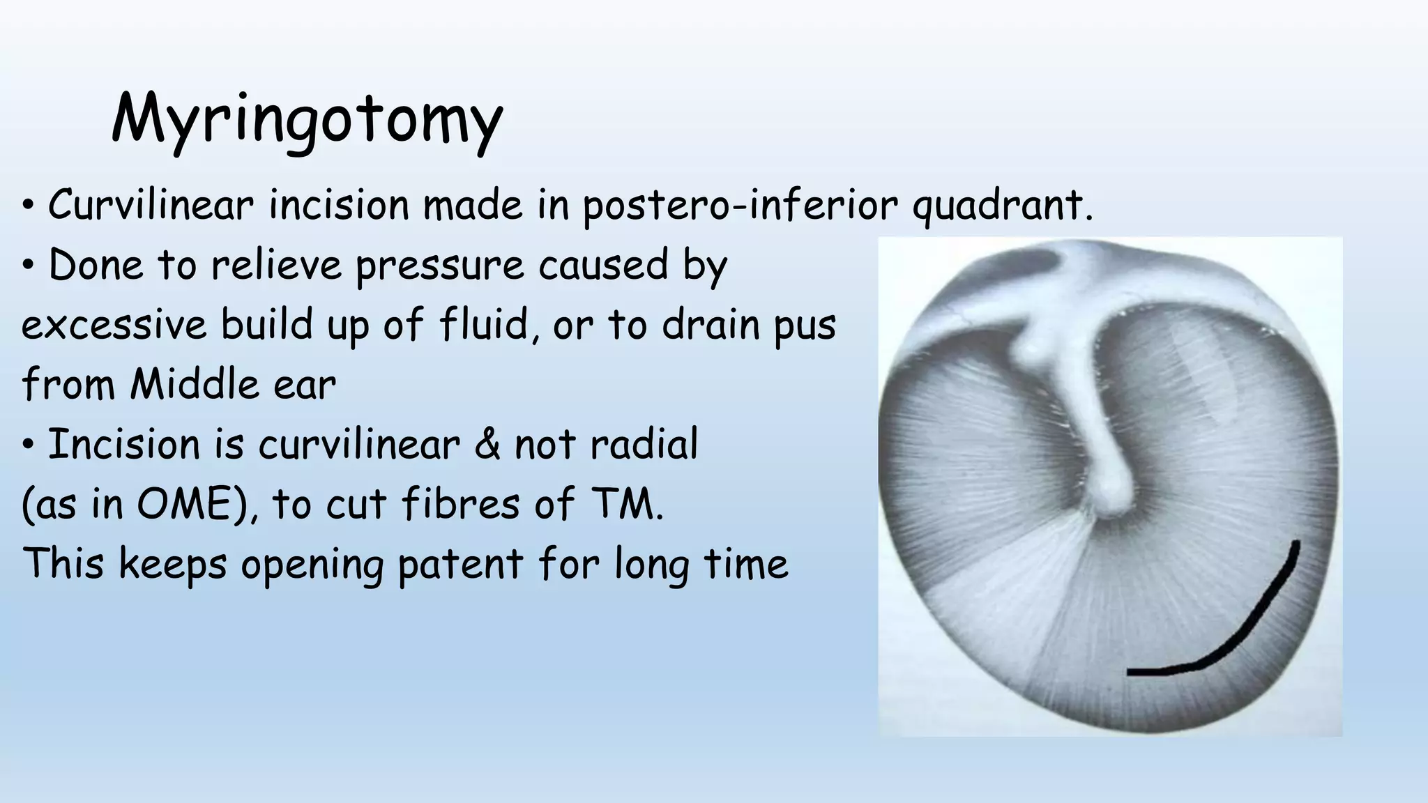 Acute suppurative otitis media | PPTX