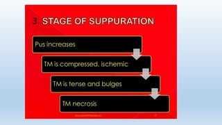 Acute suppurative otitis media | PPTX