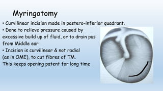 Acute suppurative otitis media | PPTX