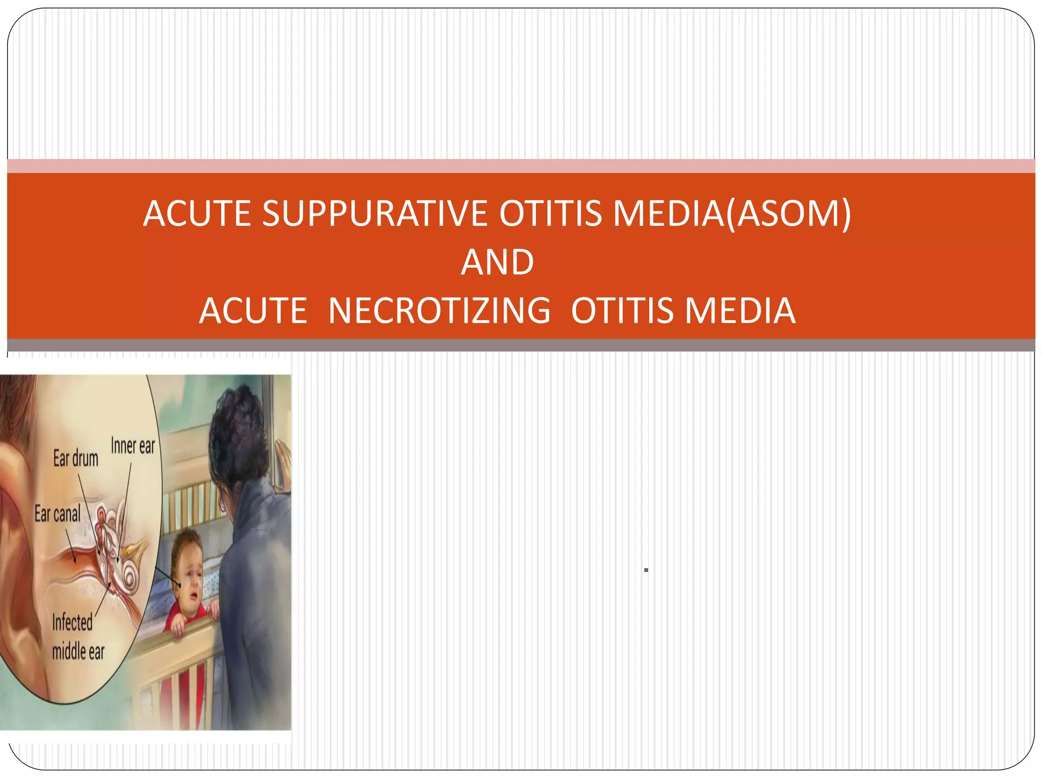 Acute suppurative otitis media | PPTX