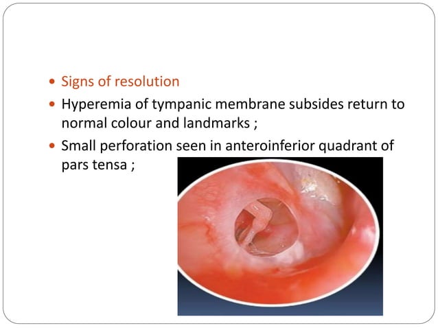 Acute suppurative otitis media | PPT